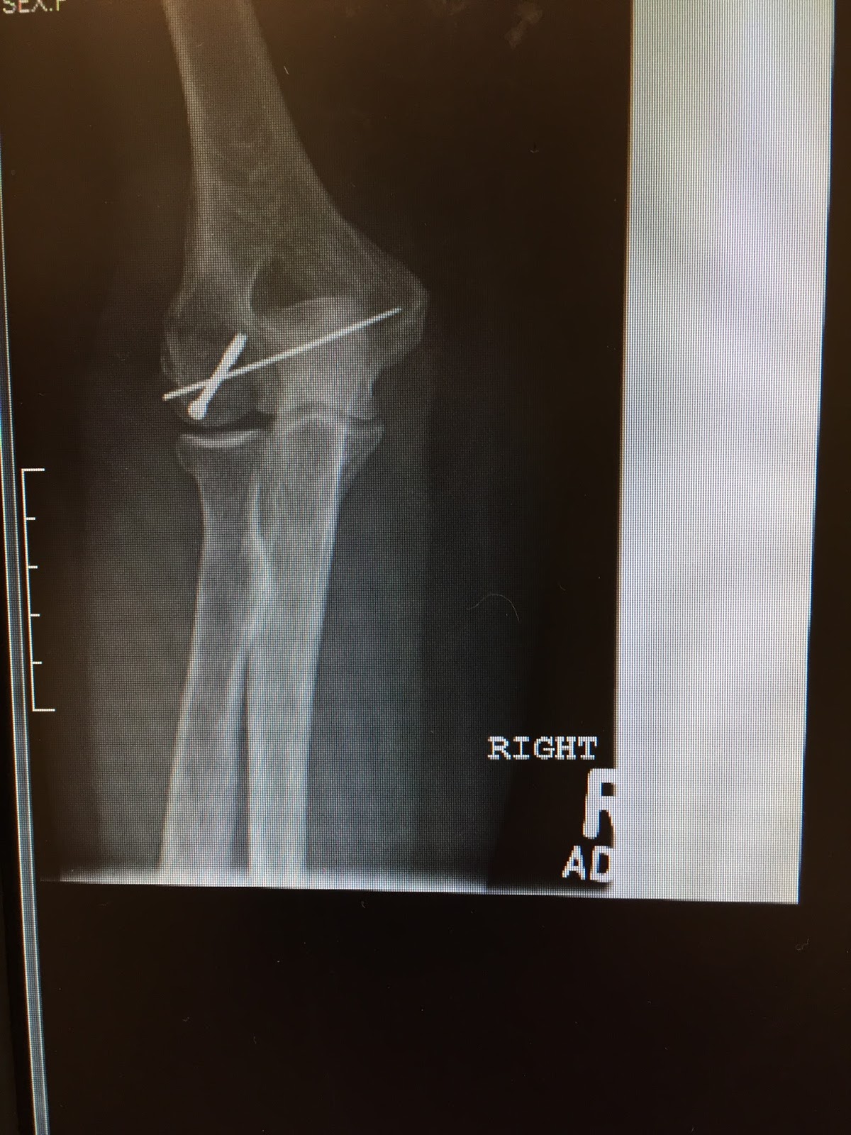 Shoulder and Elbow Surgery: Shear fractures of the capitellum.