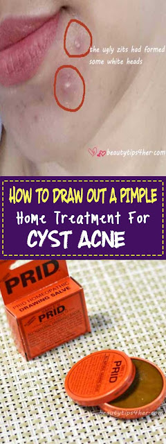 How to Draw Out a Pimple – 4 Home Remedies for Cysts Acne – Home ...