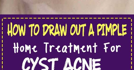 How to Draw Out a Pimple – 4 Home Remedies for Cysts Acne – Home ...