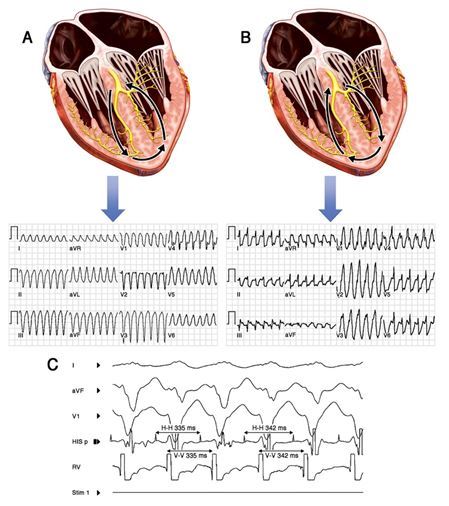 Bundle Branch Reentrant Ventricular Tachycardia - Kelainan EKG Bundle Branch Reentrant Ventricular Tachycardia - Kelainan EKG
