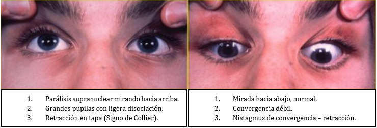 Síndrome de Parinaud