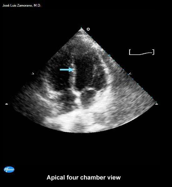 Echocardiography (USG Jantung)
