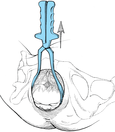 học Y: forceps - ventouse