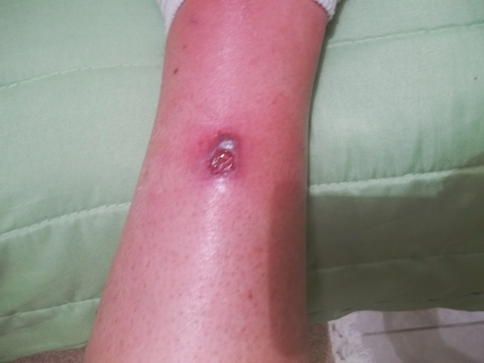 Running the race....: Tropical Ulcers (Mostly a completely medical post)