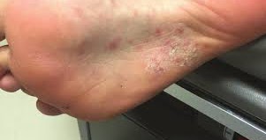 What is Condyloma lata - Definition, Symptoms, Causes, Treatment ...