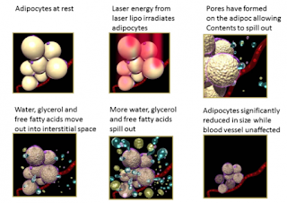 Medical laser beauty