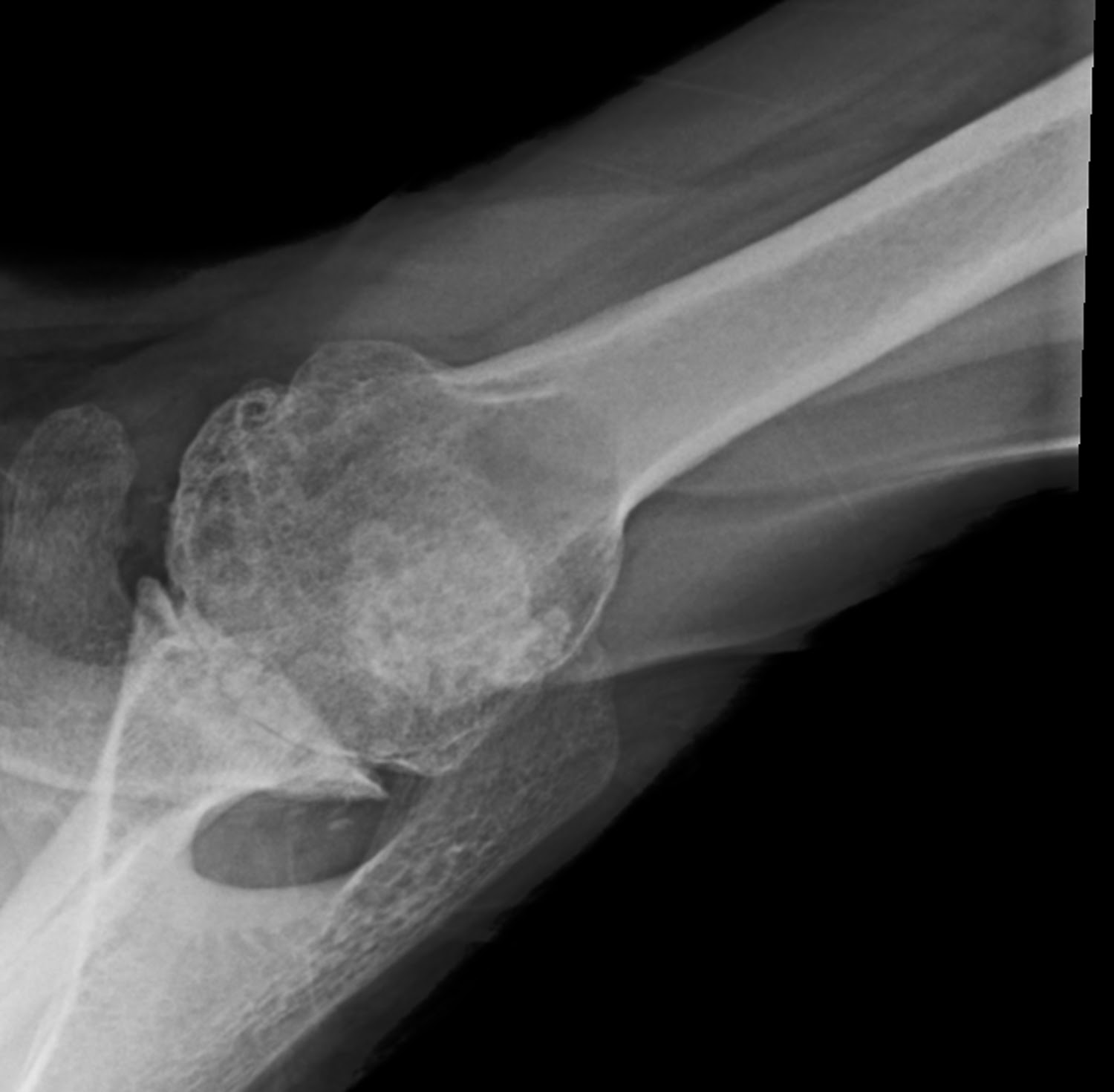 UW Shoulder and Elbow Academy: Shoulder joint replacement - special ...