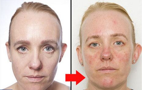 Kulit Wajah Rusak Akibat Malas Mencuci Wajah | Resep Kecantikan