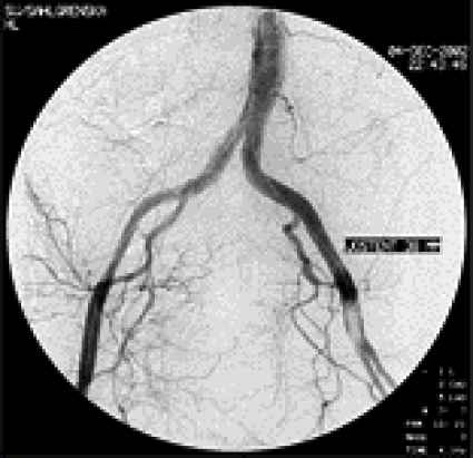 Asri Wulandari: Dari Angiografi ke Radiologi Intervensional