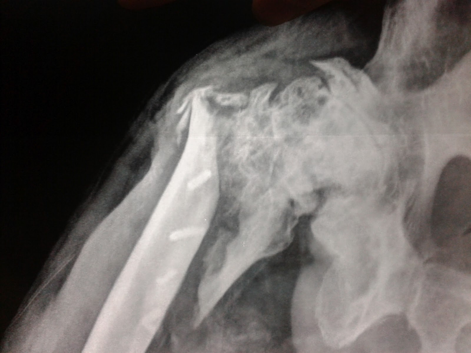 Joint Preservation and Replacement : Complex Hip- OA with intertroch ...
