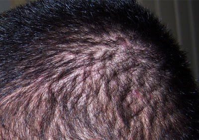 What Causes Scalp Acne?