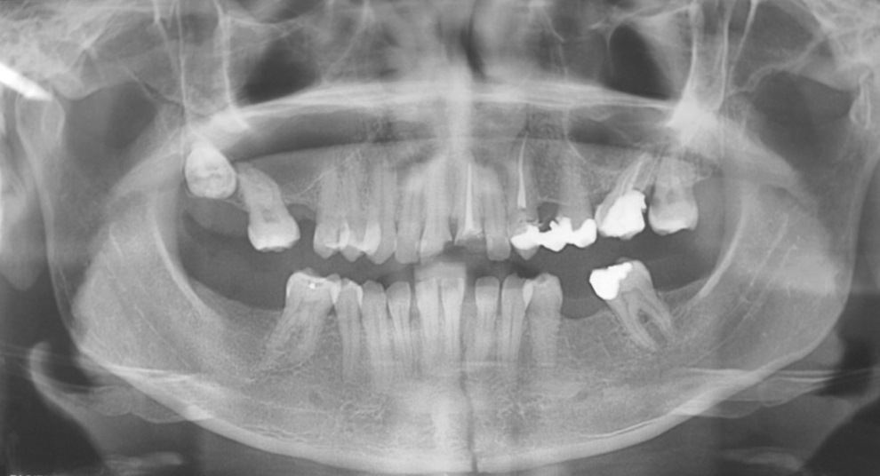 Fratura Mandibular por Acidente Motociclístico - CIRURGIA BUCOMAXILOFACIAL