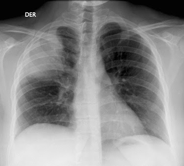 Neumología para estudiantes: NEUMONÍA