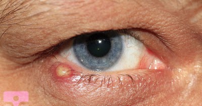 Barley on The Eye Symptoms, Causes and Treatment