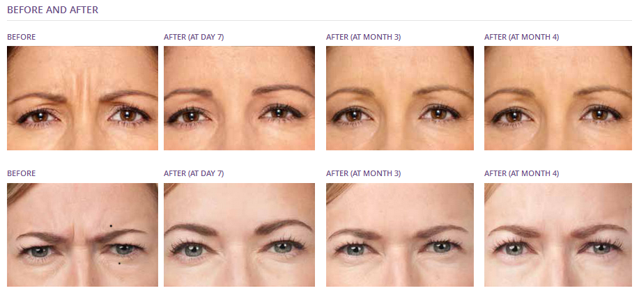 Things you should consider before choosing the right Wrinkle treatments ...