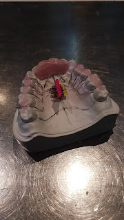 Ortodoncia aplicada a la prótesis dental: Acrilado de la placa Hawley