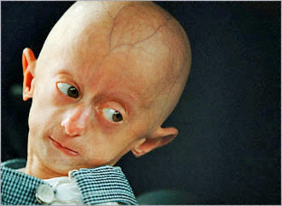 progeria family circle: erfelijkheid