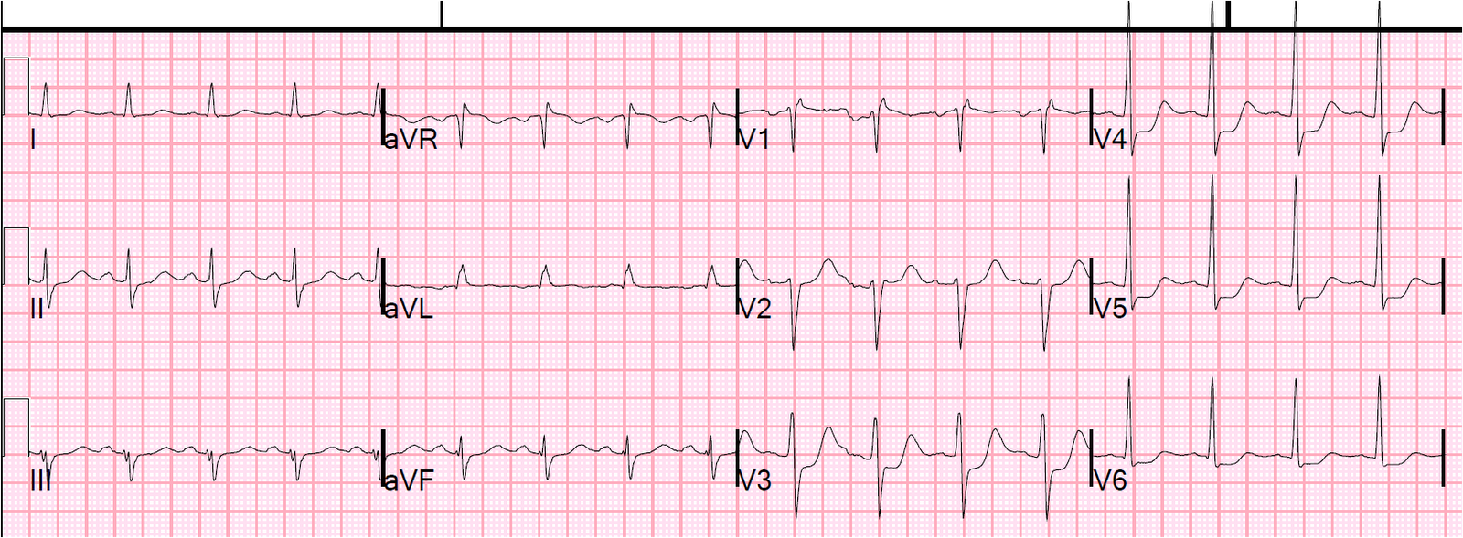 Dr. Smith's ECG Blog: ST depression after cardiac arrest is frequently ...