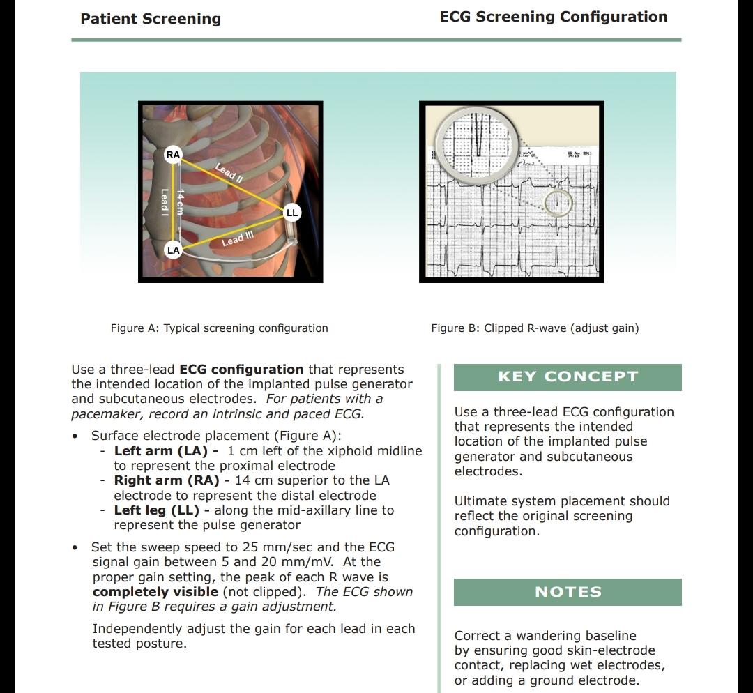 CVT Mohd Farid: Implant Management Of Subcutaneous ICD Boston Emblem SICD