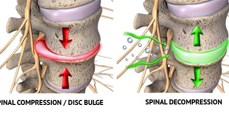 Spinal Decompression Therapy