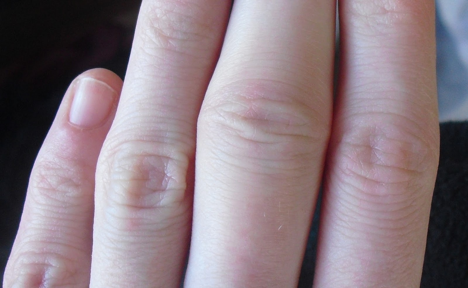 Galgbacken bloggen: Stukat finger