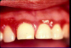 Kesan pertama: Gingivitis