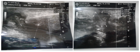 Pengalaman operasi sesar akibat benjolan kecil di bawah pusar ...