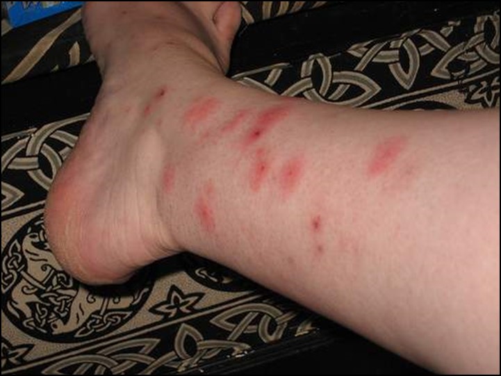 Hygiene-Netzwerk: Urteil – Bettwanzenbisse in Wohnung können für den ...