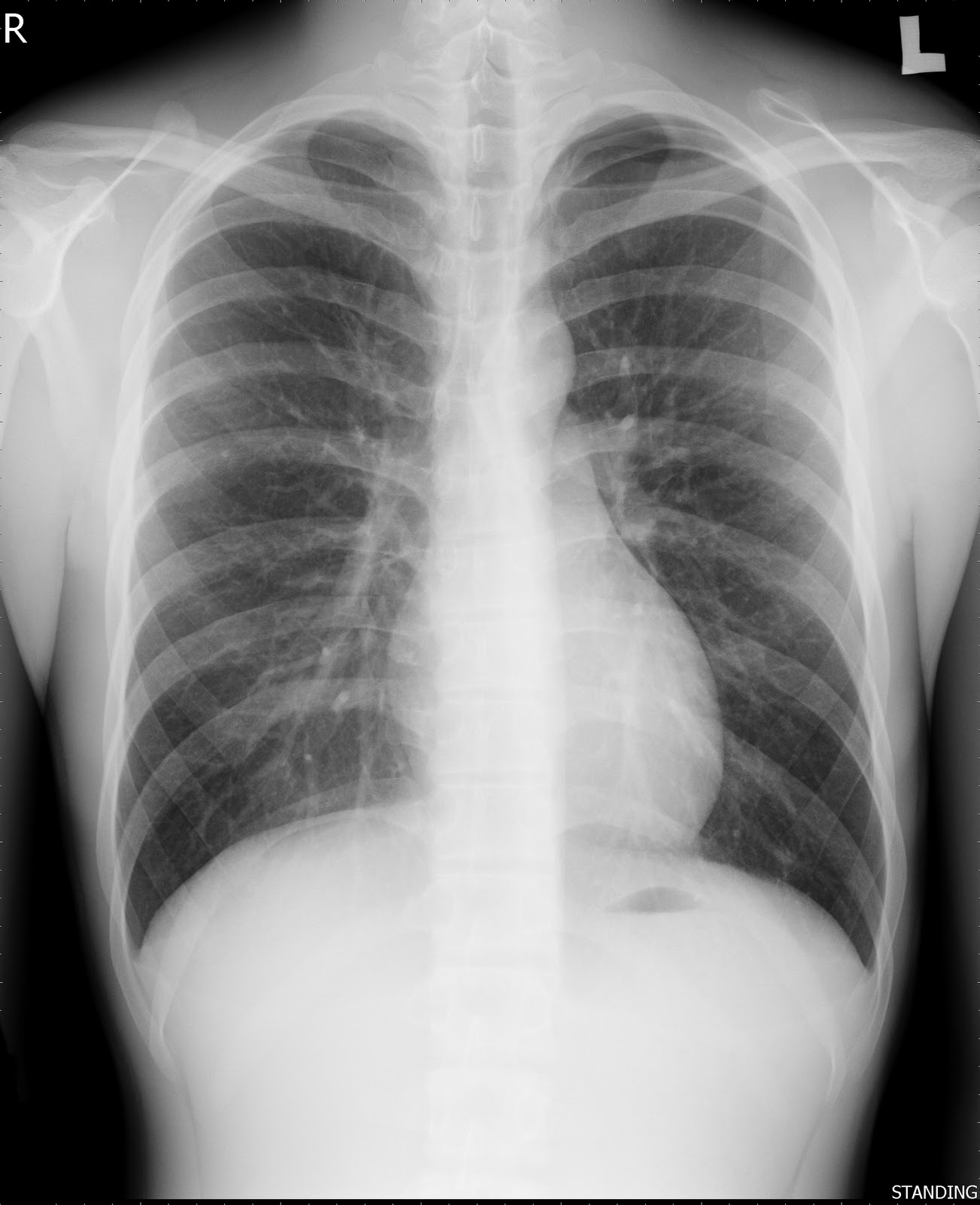 CXR 胸部x光判讀 pneumothorax