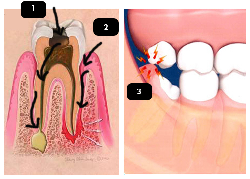 Penyebaran Infeksinya Hingga ke Seluruh Tubuh.. Jangan Remehkan Sakit Gigi