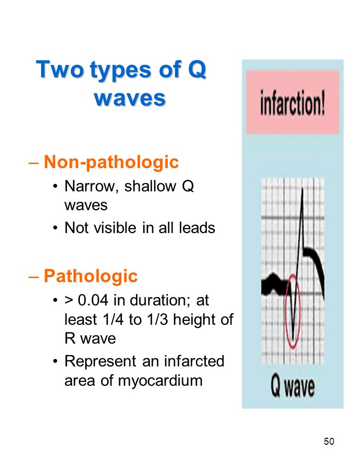 Gelombang Q | INA - ECG
