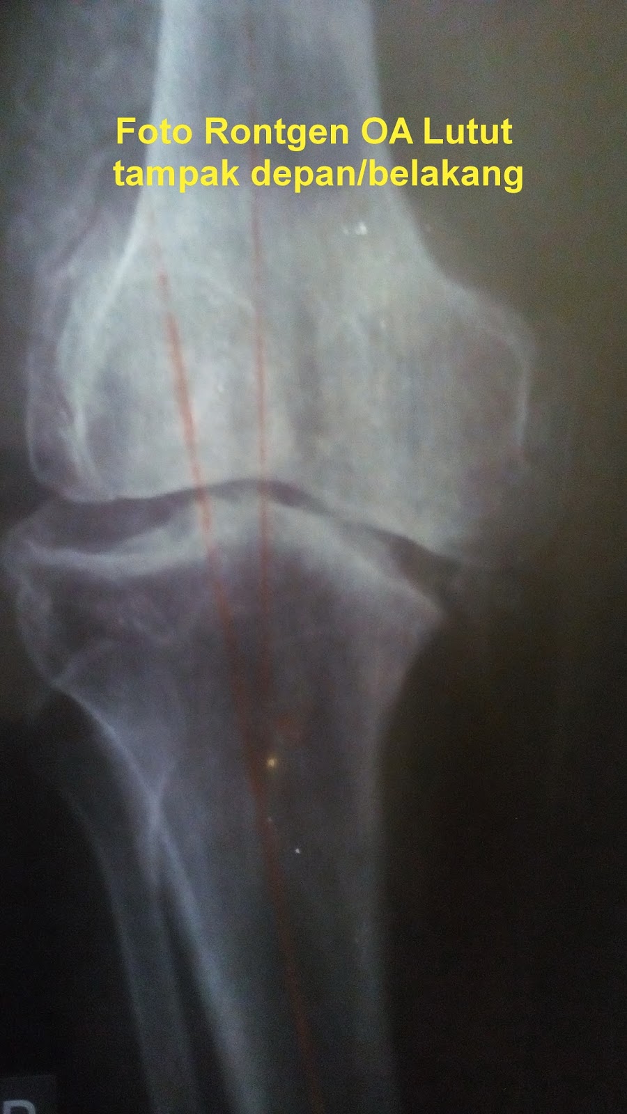 Laihan Pasca Operasi Ganti Sendi Lutut ~ Sendi, Tulang, Otot dan Tulang ...