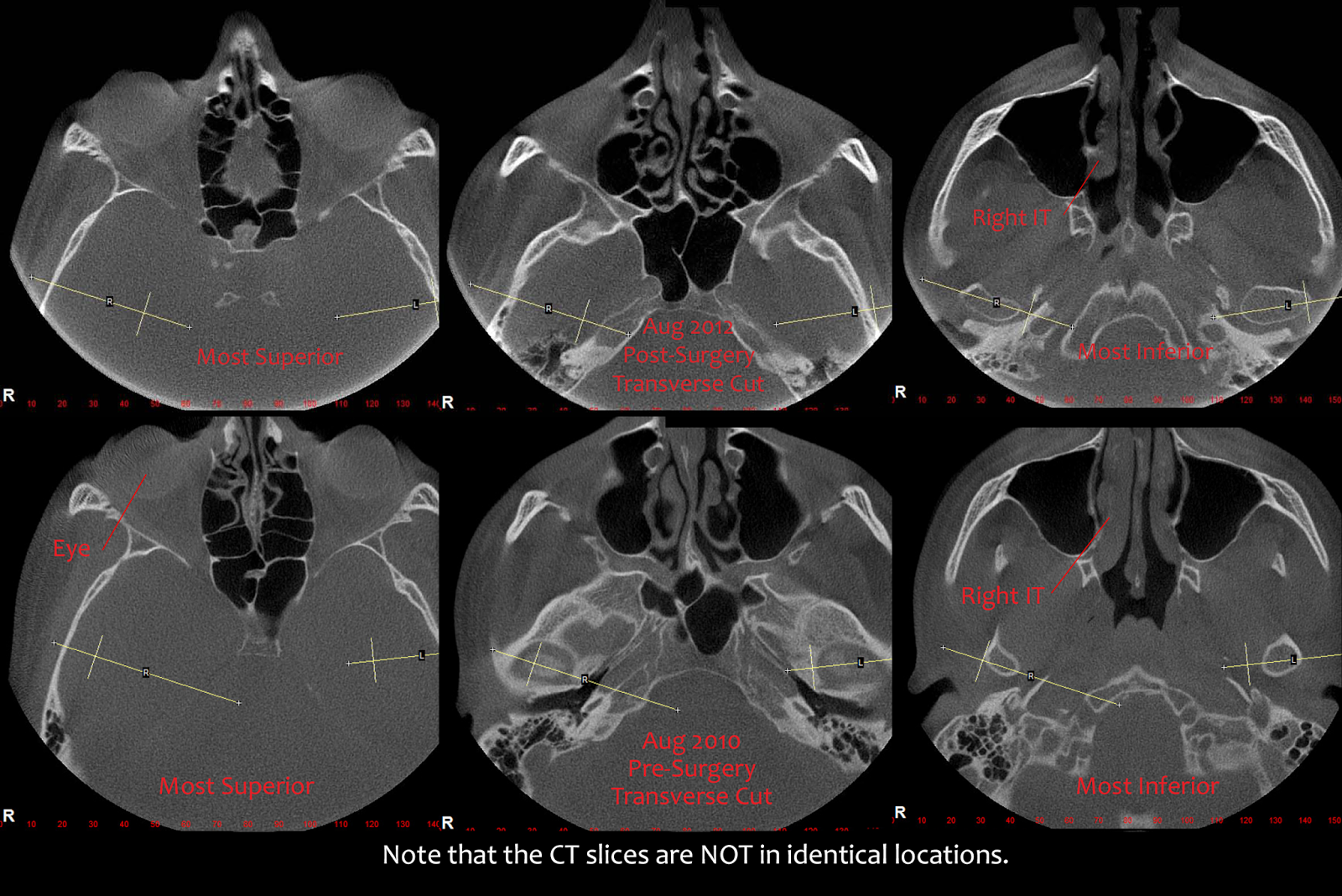 Post Septoplasty and Turbinate Reduction (ENS): 2014