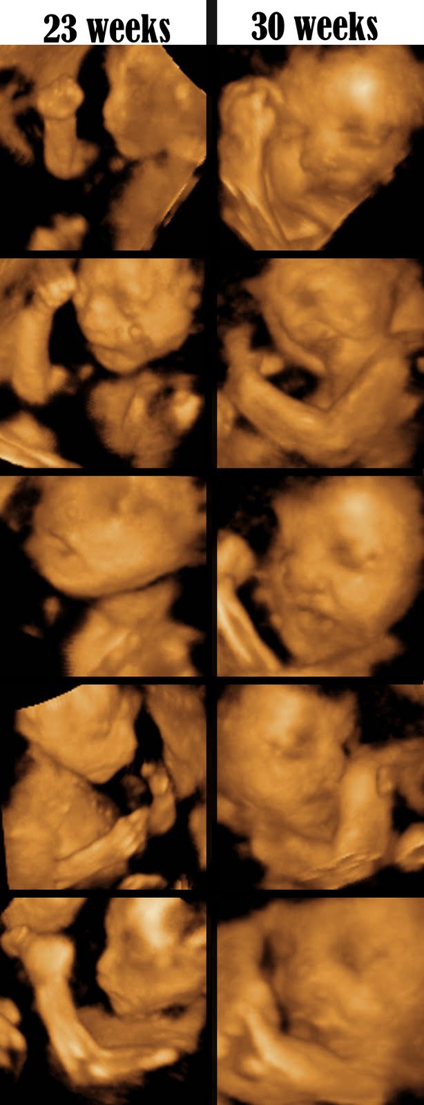 Making mEmerys: 3D/4D Ultrasound-30 Weeks