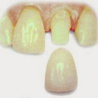 Ingin Tahu: Prostodonsia: GTSL (gigi Tiruan Sebagian Lepasan) & GTC ...