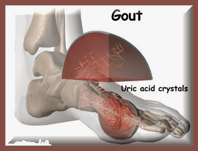 Panduan Kesihatan Kita: Pengambilan Gula berlebihan juga penyebab "GOUT"