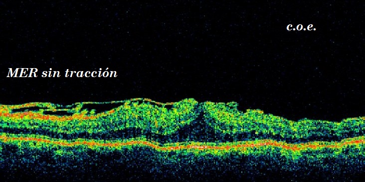 DEGENERACION MACULAR : OCT retina V