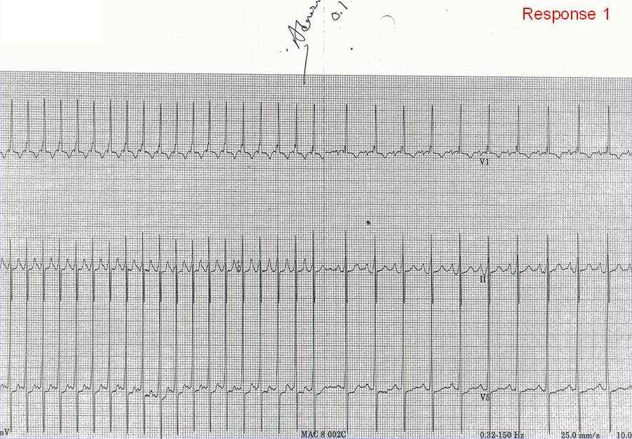 Pedi cardiology: Narrow Complex Tachycardia/SVT - 3 types of responses ...