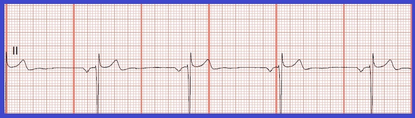 Characteristics of Junctional Rhythms