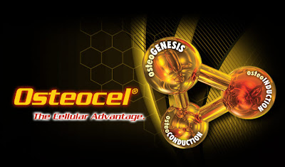 Periodontia e Implantes: Osteocel - mais uma opção de produto com ...