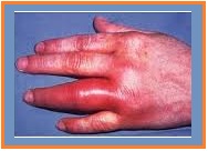 BIOLOGI GONZAGA: SEKILAS TENTANG INFLAMASI