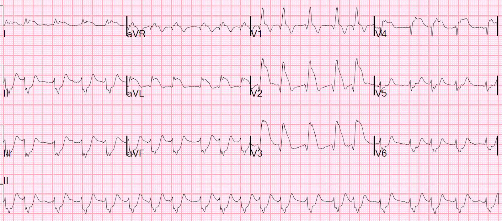 Dr. Smith's ECG Blog: What, besides large anterior STEMI, is so ominous ...