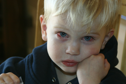 Homoeopathy for Kids: HOMOEOPATHY FOR CONJUNCTIVITIS OR PINK EYE OR ...