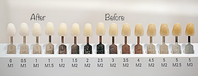 My First Time Doing Teeth Bleaching - Sapphire Smile Dental - Stella ...