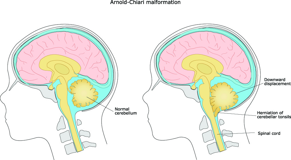Κωνσταντίνος Χ. Δαβανέλος: Δυσπλασία Arnold-Chiari.