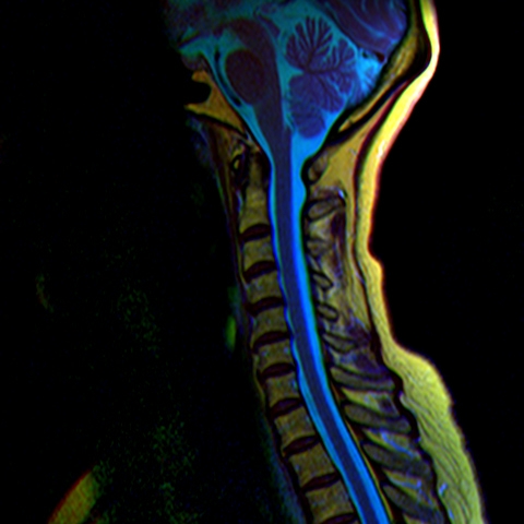 Nevit's blog: Cervical spine Color MRI
