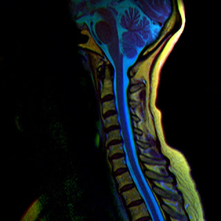 Nevit's blog: Cervical spine Color MRI