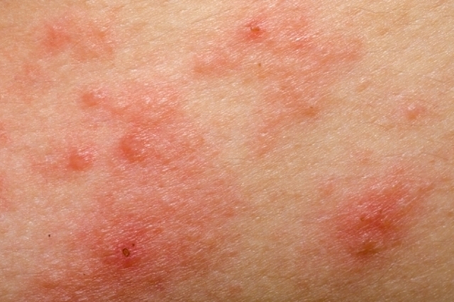 Manchas en la piel