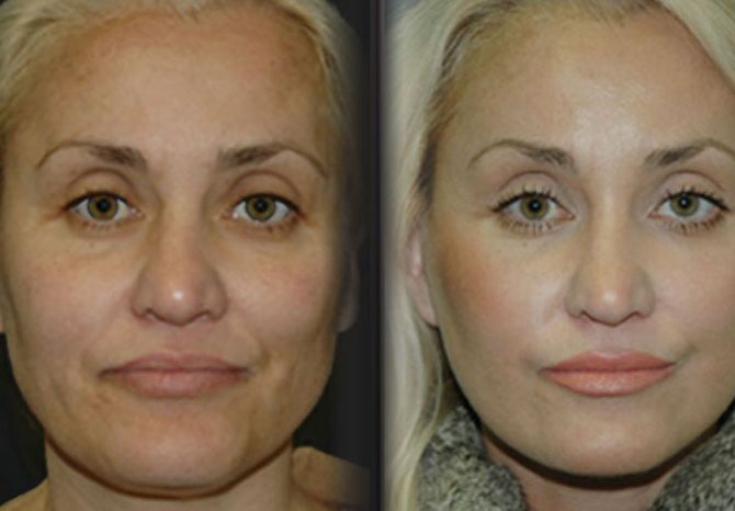 Flexing Your Face With Facial Gymnastics To Gain A Non-Surgical ...