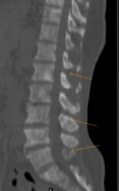 Osteoblastic Secondaries-CT - Sumer's Radiology Blog